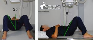 Radiología de la cadera - Artroscopia de Cadera Colombia